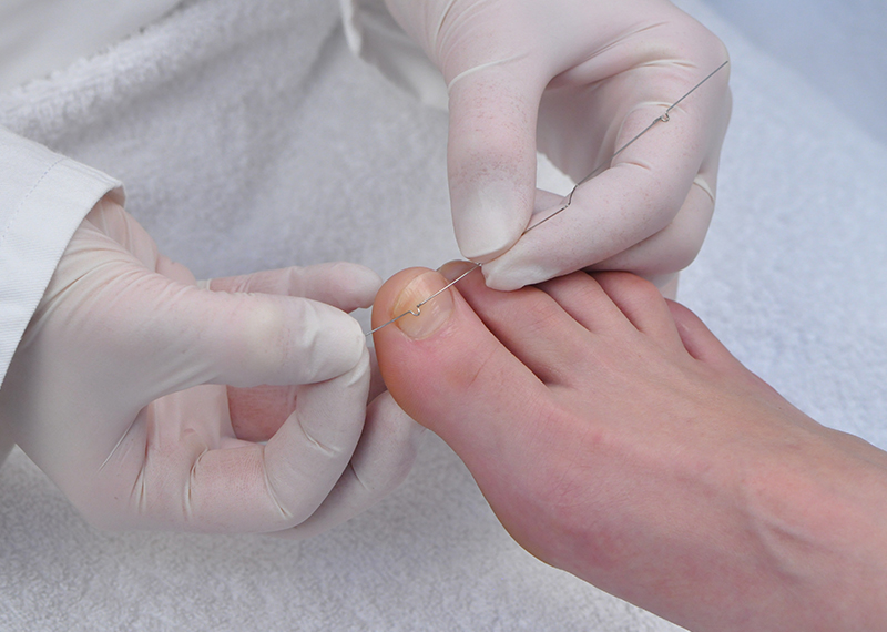 Behandlungsschwerpunkt Orthonyxie Behandlung - Nagelkorrektur